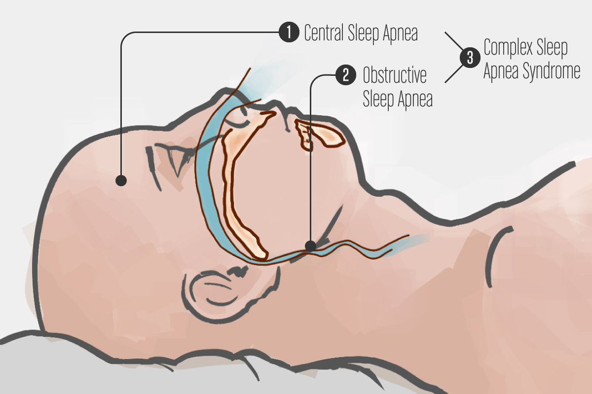 9 Signs You May Have Sleep Apnea - Help You Rest